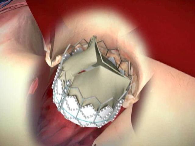 New Heart Valve Procedure Replaces Major Surgery – NBC10 Philadelphia