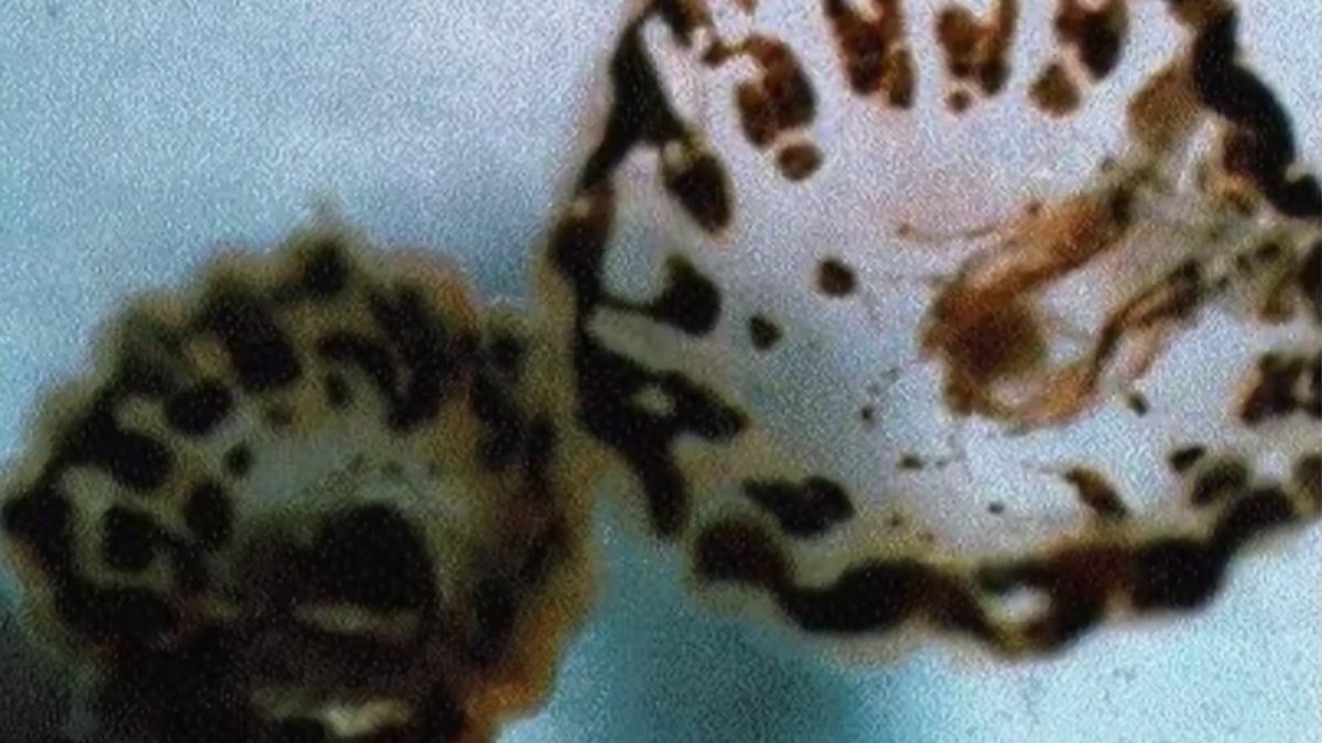 Uptick in Sea Lice Leads to Itchy Situation at Jersey Shore Beaches ...