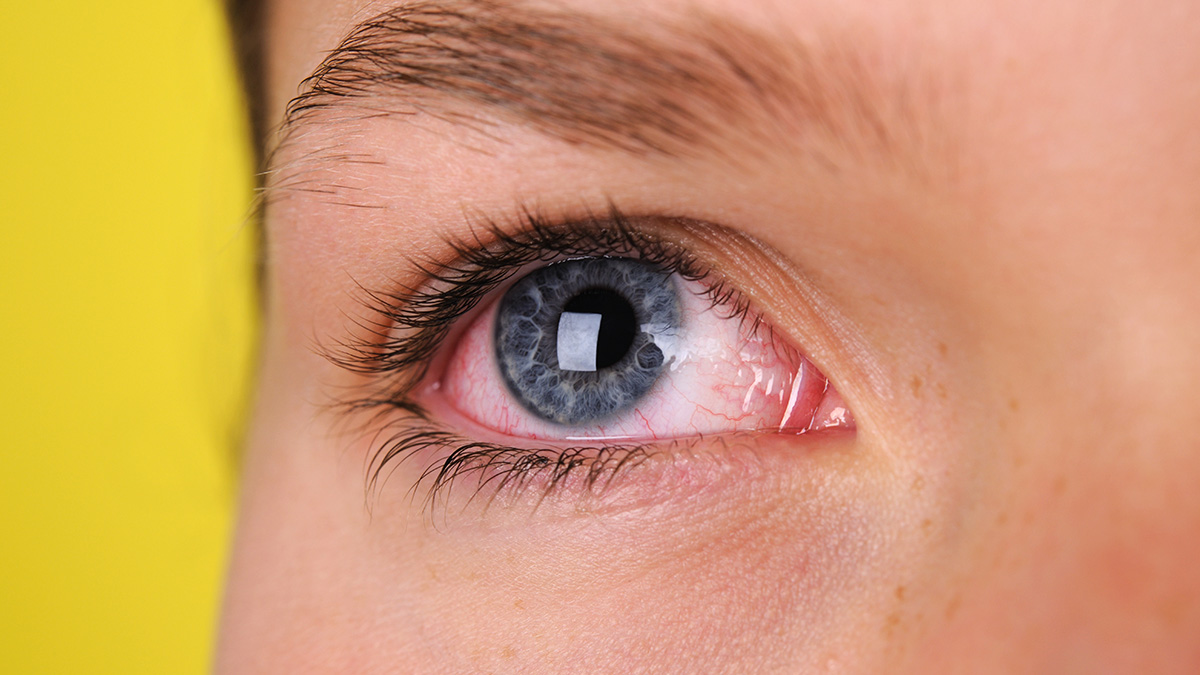 What is eye syphilis? Doctor explains ‘devastating’ complication of STD ...