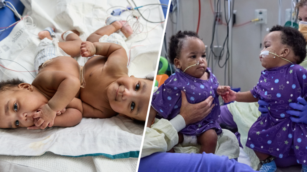Conjoined twins successfully separated at CHOP – NBC10 Philadelphia